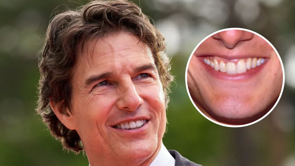 Tom Cruise Teeth: Before & After Veneers, Cost, Timeline | MySmileFinder